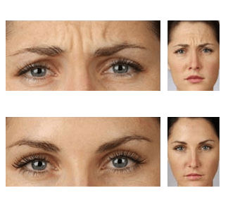 Botox Προσώπου: Επεμβάσεις, Συμβουλές, Παρενέργειες, Αισθητική ...